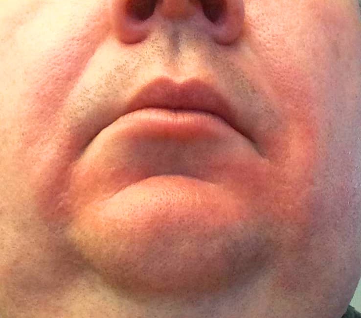 CPAP Mask Rash Surviving Sleep Apnea